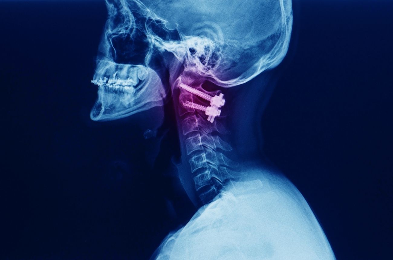 Cervical Radiculopathy Pinched Nerve Meaning Signs Causes